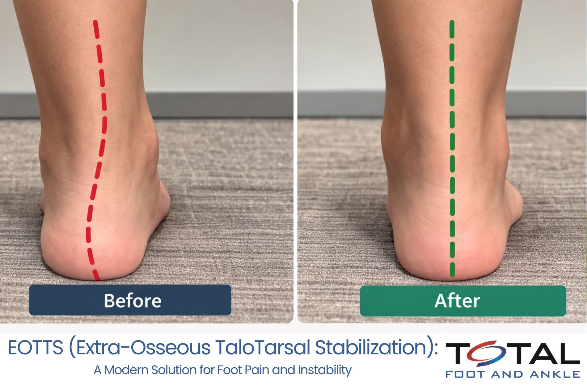 EOTTS (Extra-Osseous TaloTarsal Stabilization): A Modern Solution for ...
